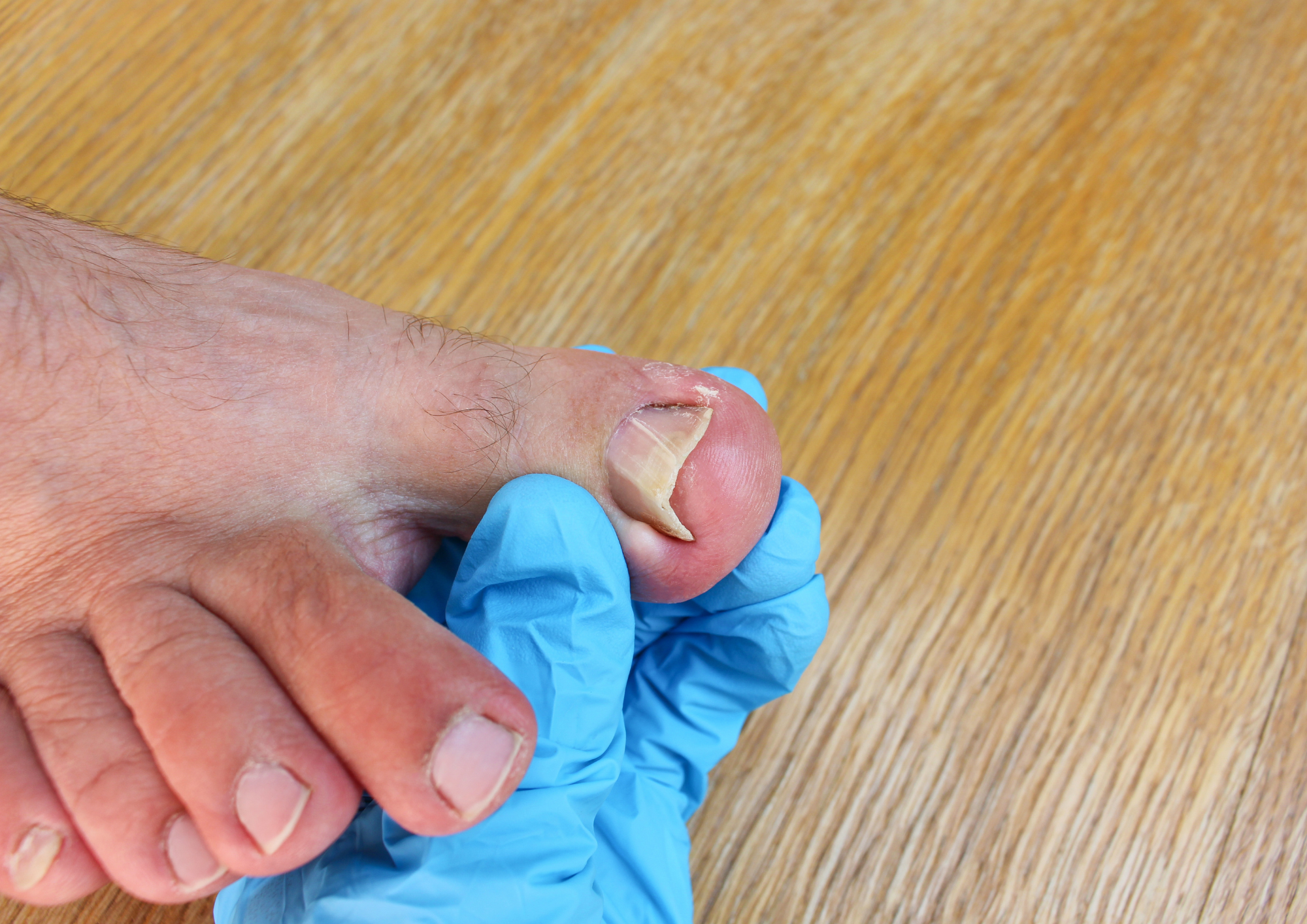 Fungal and Ingrown Toenails – Every Step Podiatry – Sydney Podiatrist