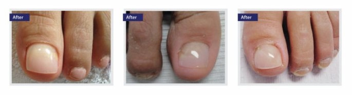 KeryFlex Nail Restoration – Every Step Podiatry – Sydney Podiatrist